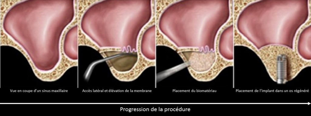 Greffe osseuse dentaire - Reconstruction osseuse | Explications