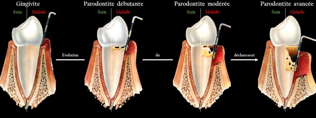 Qu'est ce qu'une Parodontite ? | Explication par un Parodontologue