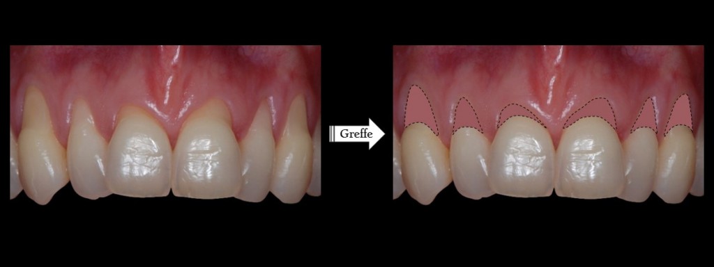 Vos gencives disparaissent ? Effectuez une greffe gingivales | Dr. Ronco