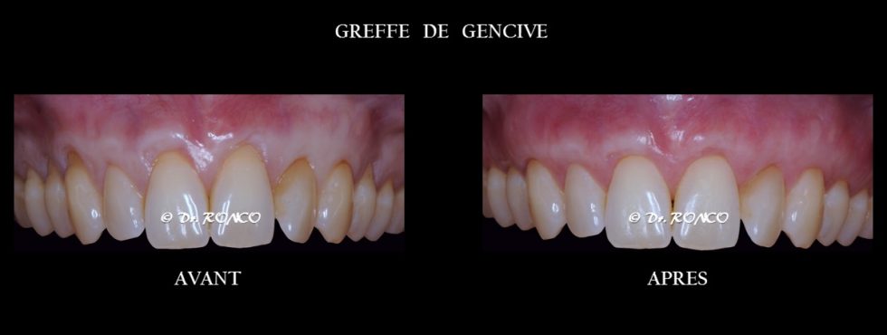 Explication de la récession gingivale | Chirurgien Dentiste Paris